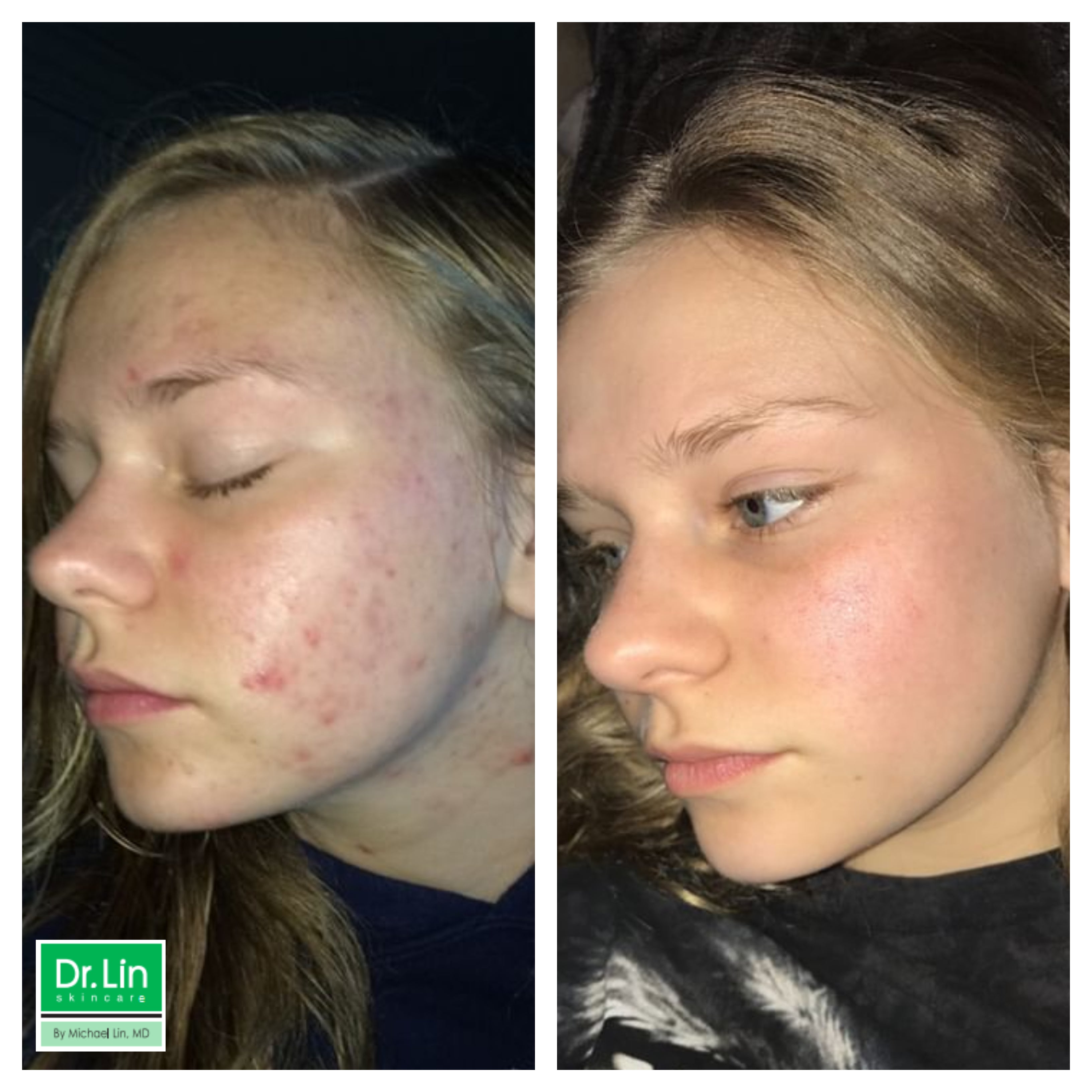 Hydroquinone Acne Scars Before And After